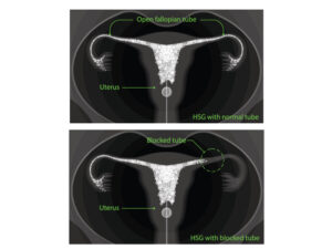 Hysterosalpingogram(HSG) Test Cost, Risks, Success Rate, Procedure ...