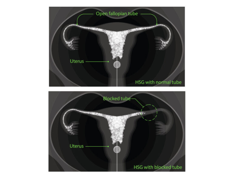 Hysterosalpingogram(HSG) Test Cost, Risks, Success Rate, Procedure ...